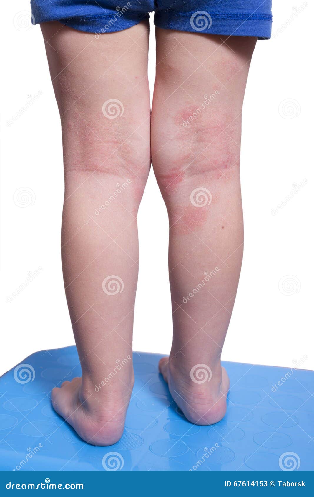 Eczema Sur Les Jambes De L'enfant Image stock - Image du patte ...