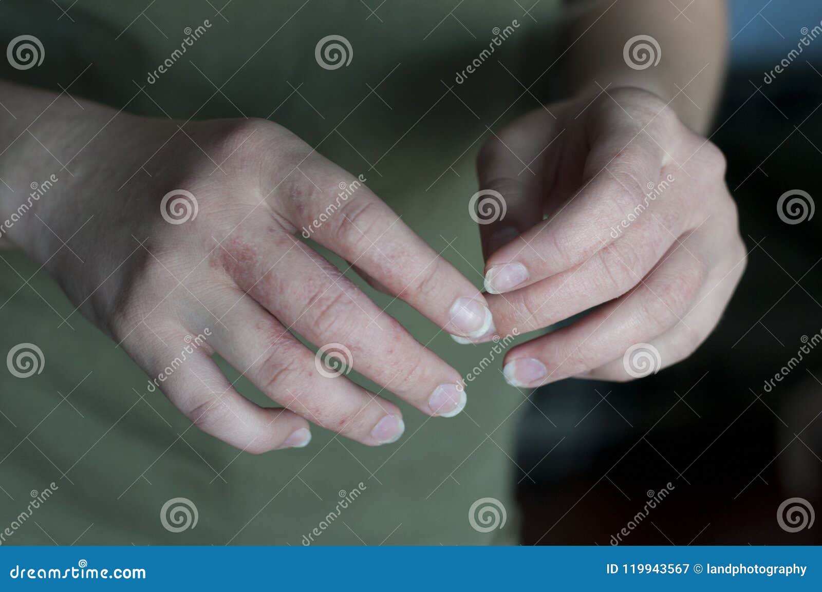 Eczema in Womans Hands. Allergy Arms Stock Image - Image of girl ...