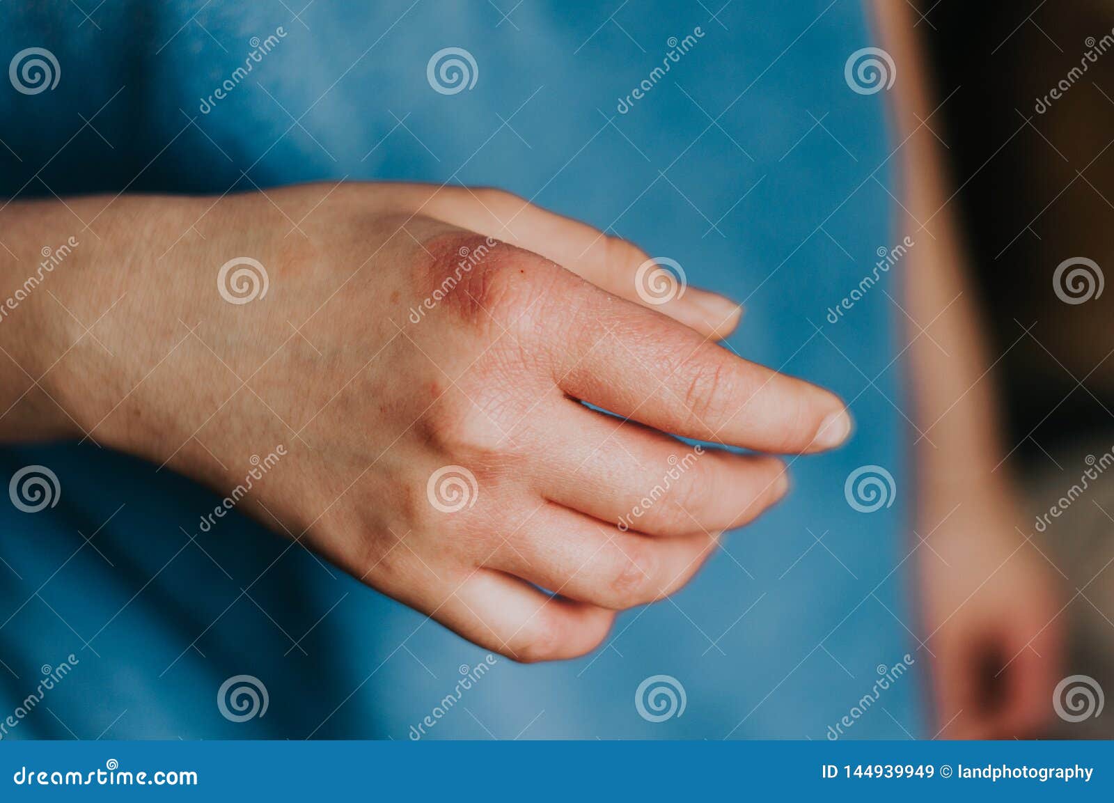 Eczema in Womans Hands. Red Allergy Problem Stock Image - Image of ...