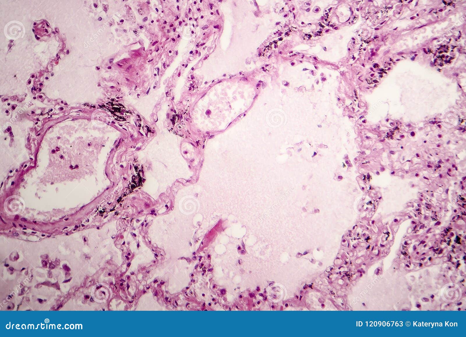 Edema polmonare acuto immagine stock. Immagine di fotomicrografo ...