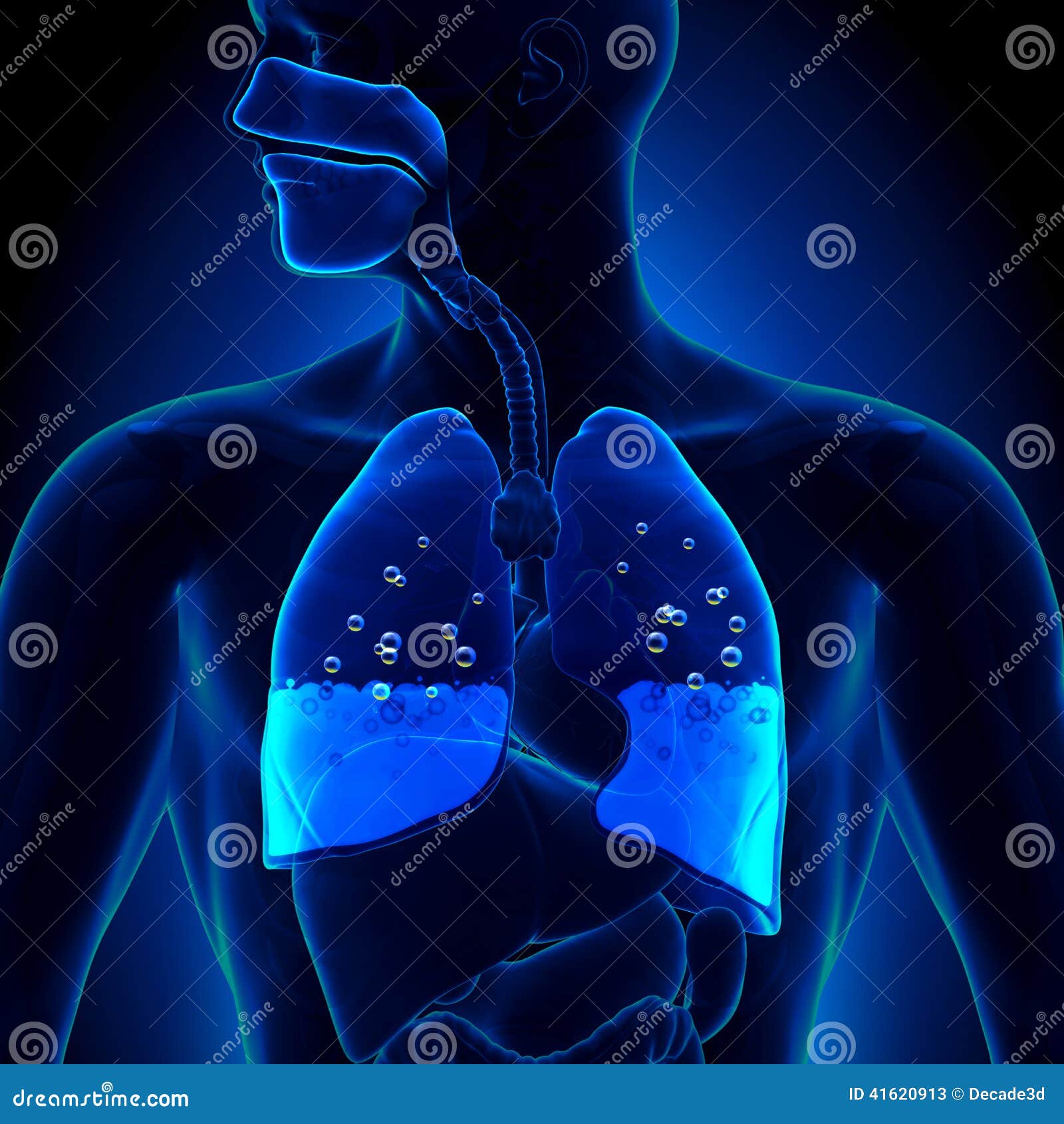 Edema Pulmonar - Agua En Pulmones Stock de ilustración - Ilustración de ...