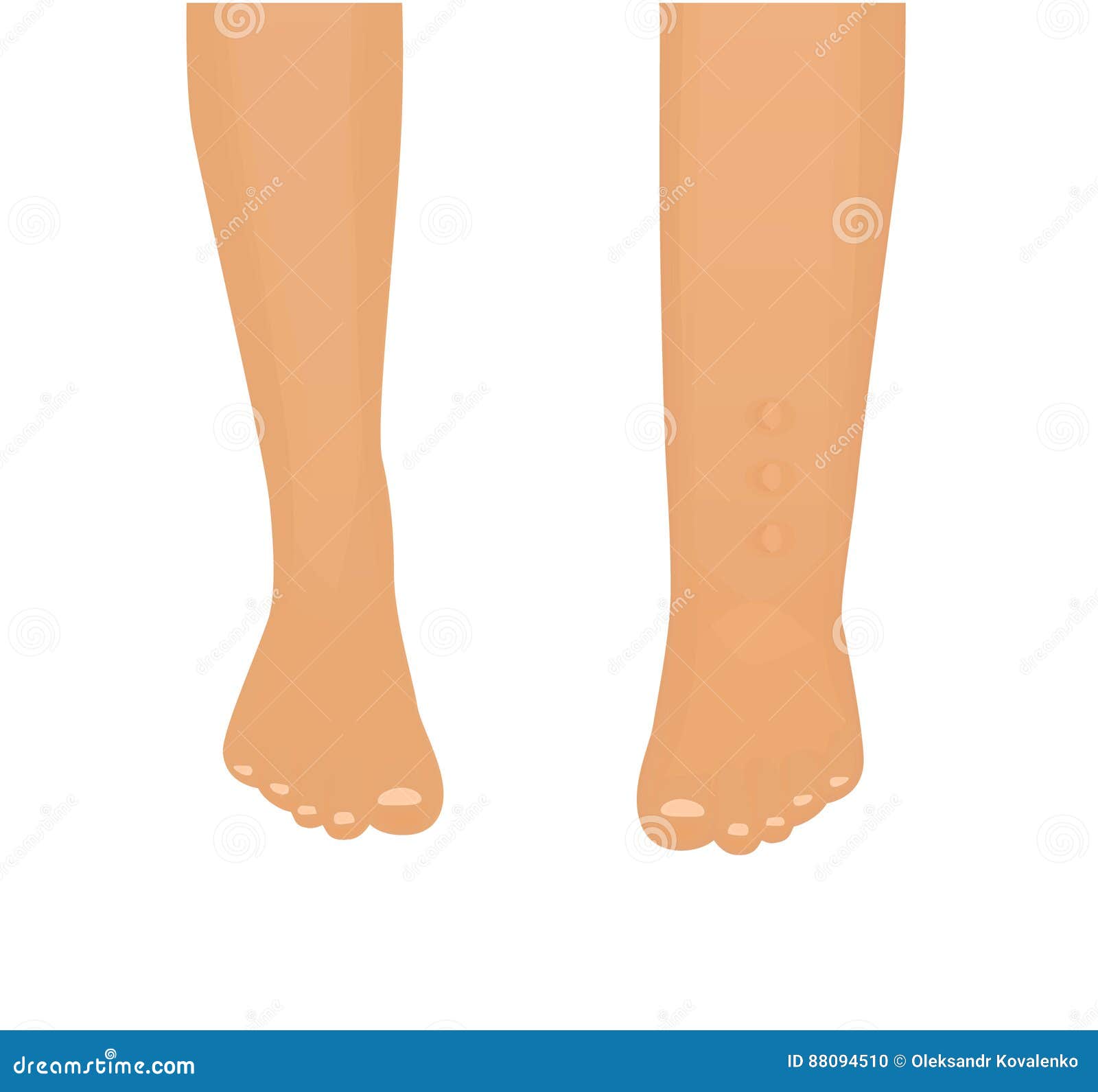 Edema vector illustration. stock vector. Illustration of legs - 88094510