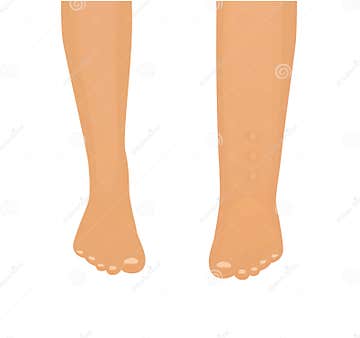 Edema vector illustration. stock vector. Illustration of legs - 88094510