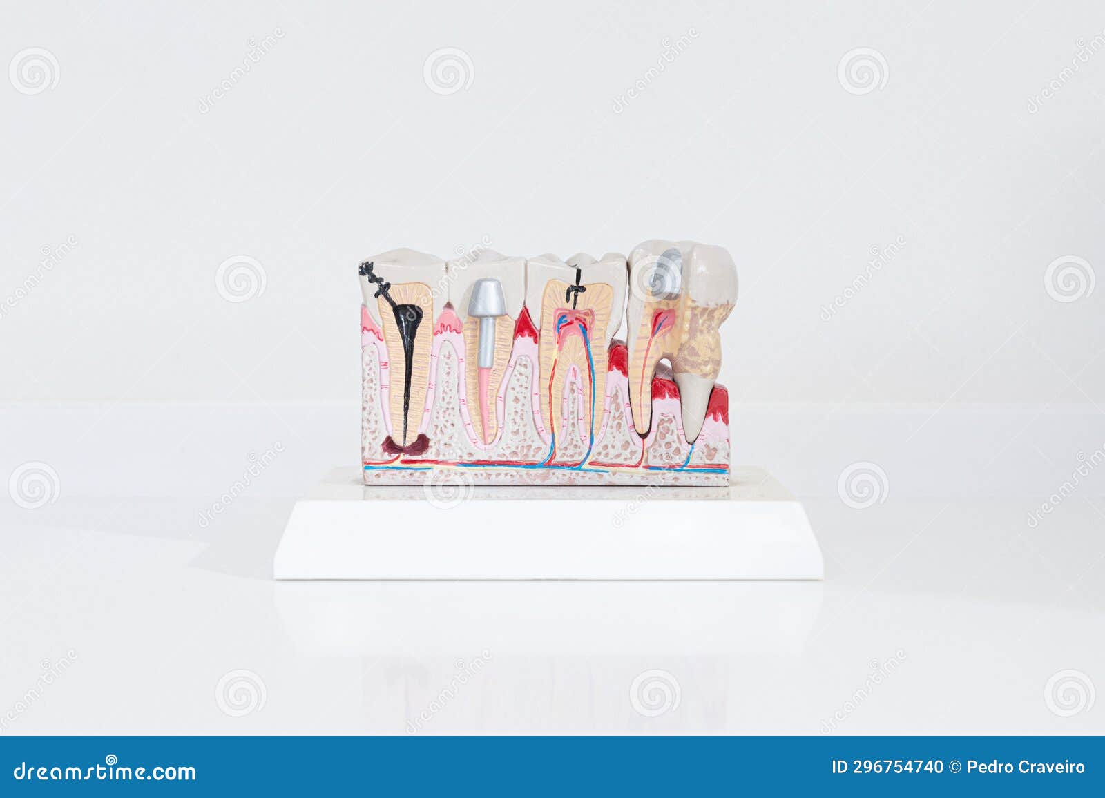 Educational Model of Tooth, Anatomy of Human Oral Tooth Stock Photo ...