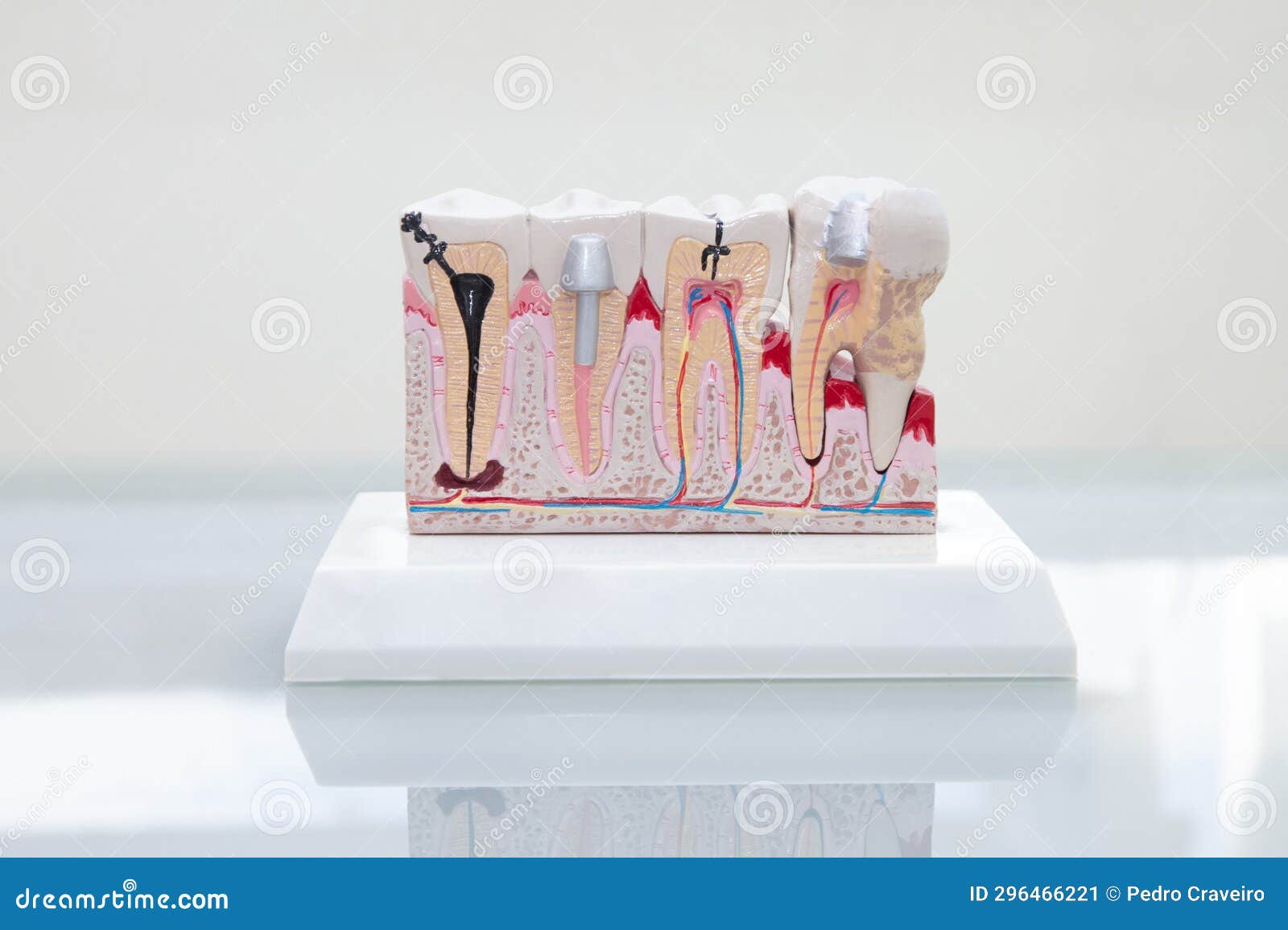 Educational Model of Tooth, Anatomy of Human Oral Tooth Stock Image ...