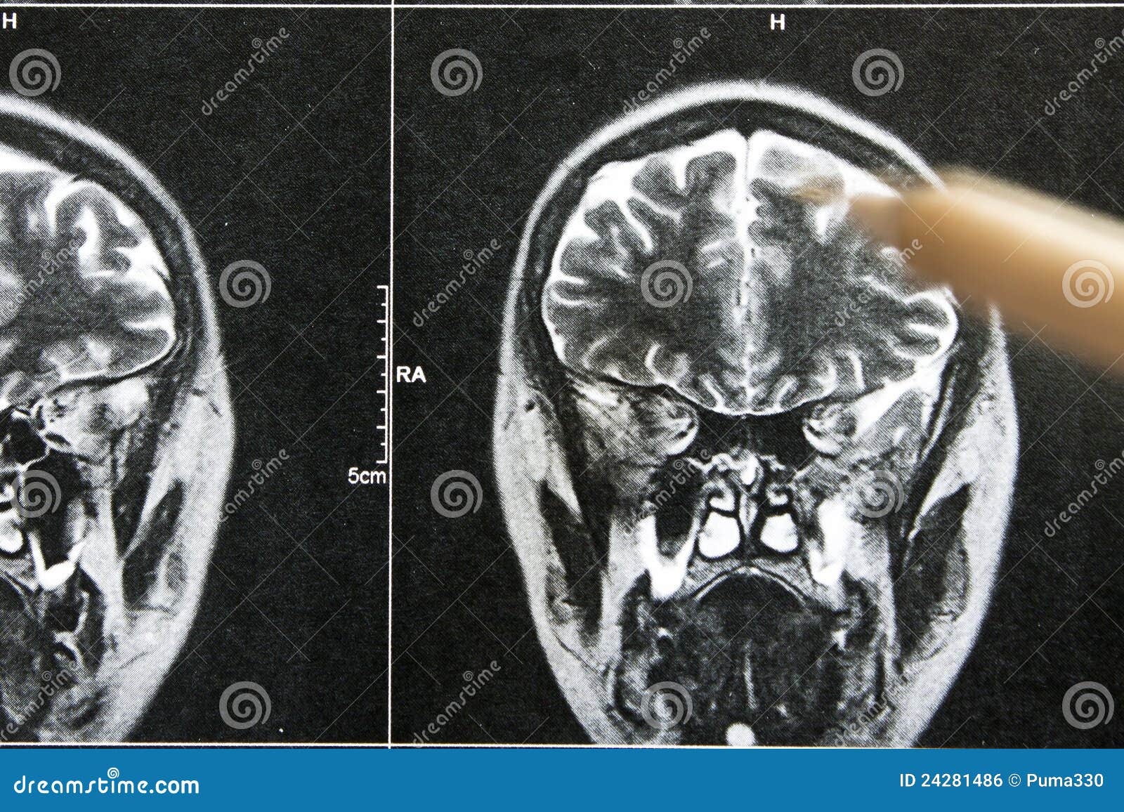 EEG x-ray skulls stock photo. Image of human, psychology - 24281486