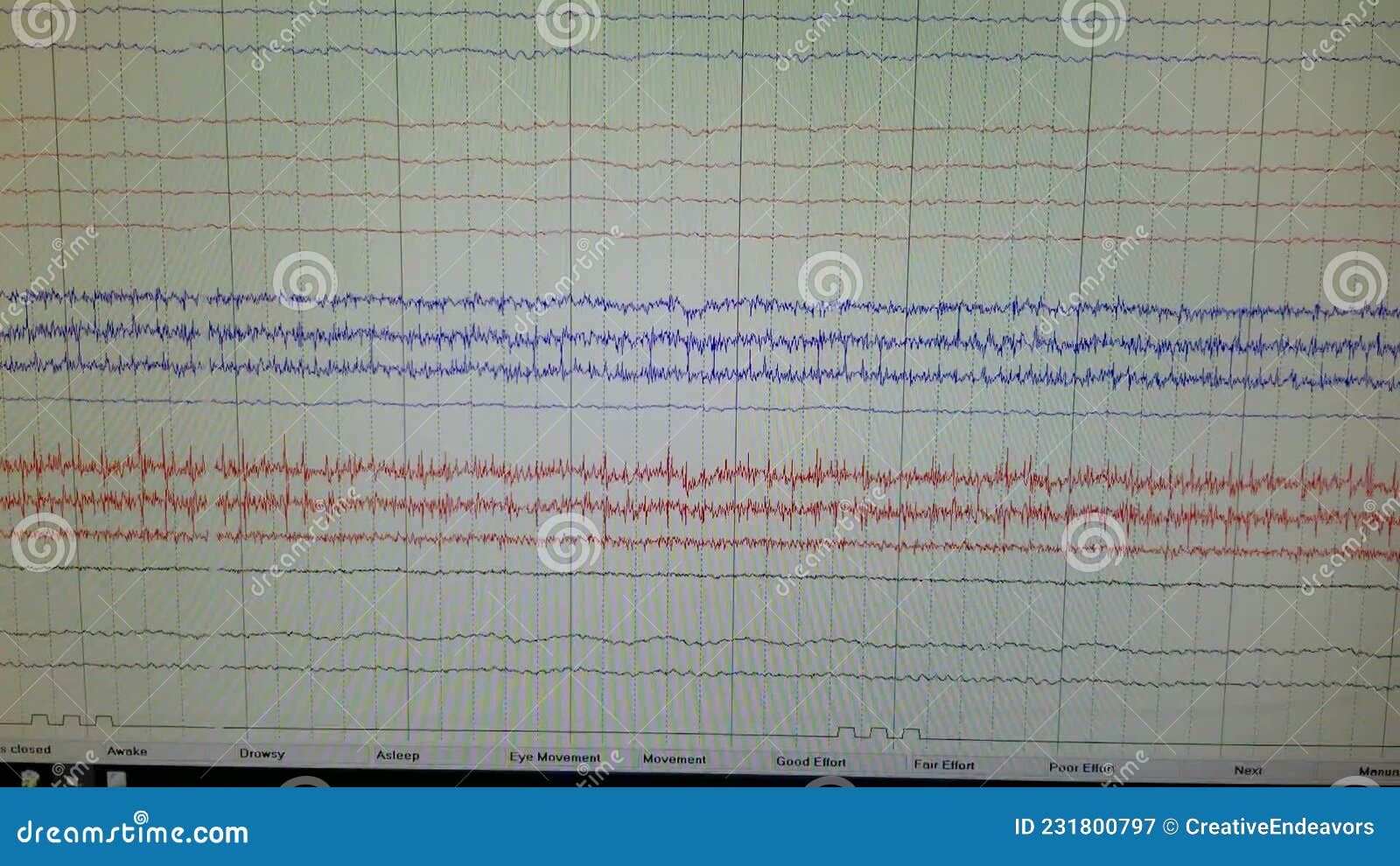 EEG Showing Brainwave Tracings from Multiple Leads Stock Video - Video ...