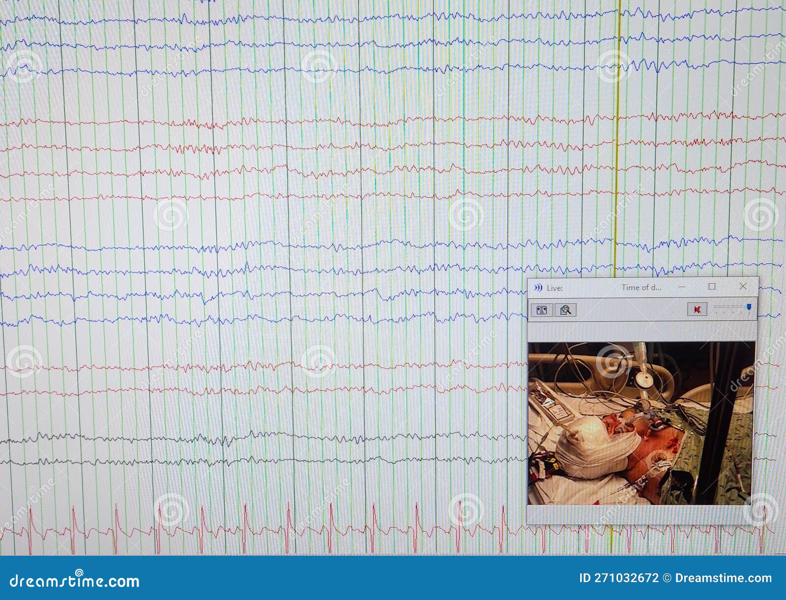 EEG Showing Diffuse Slowing on Multiple Leads Stock Photo - Image of ...