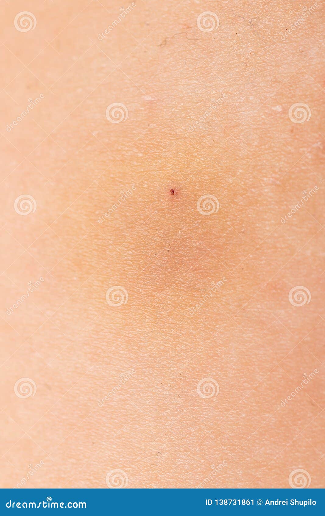 Een Kneuzing Op De Huid Van Een Mens Stock Afbeelding - Image of fysiek ...