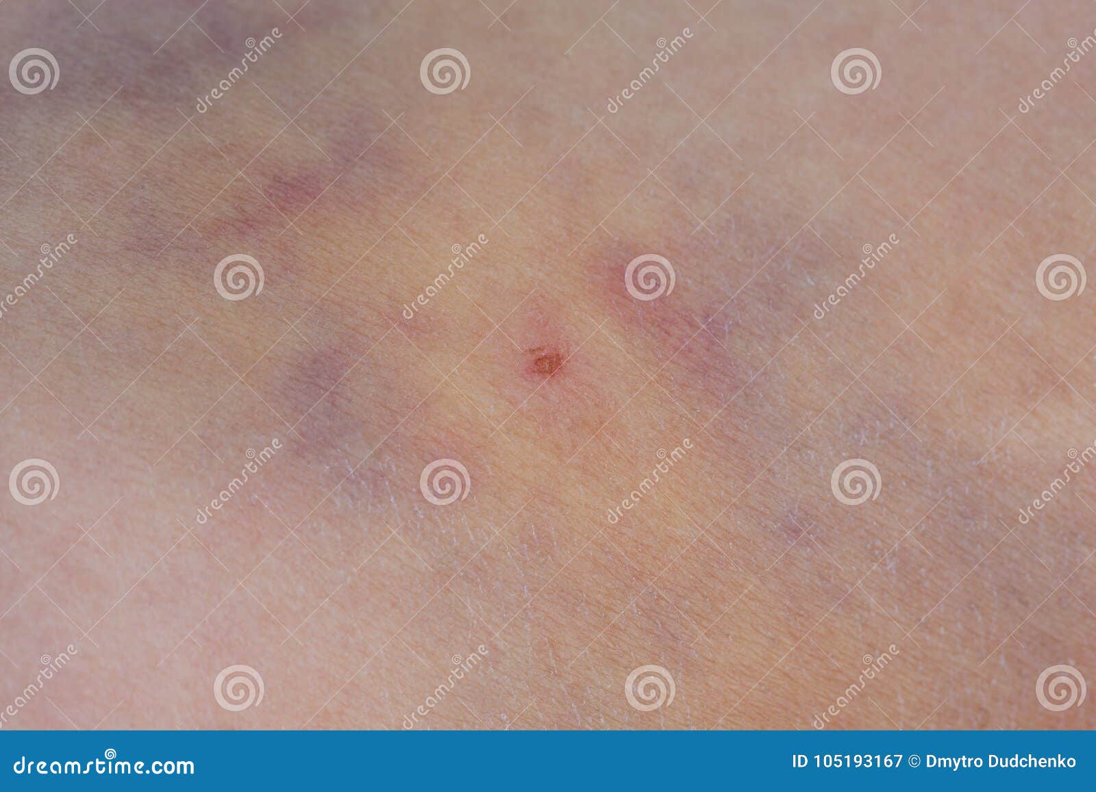 Een Kneuzing Op De Huid Van Een Persoon Stock Afbeelding - Image of ...