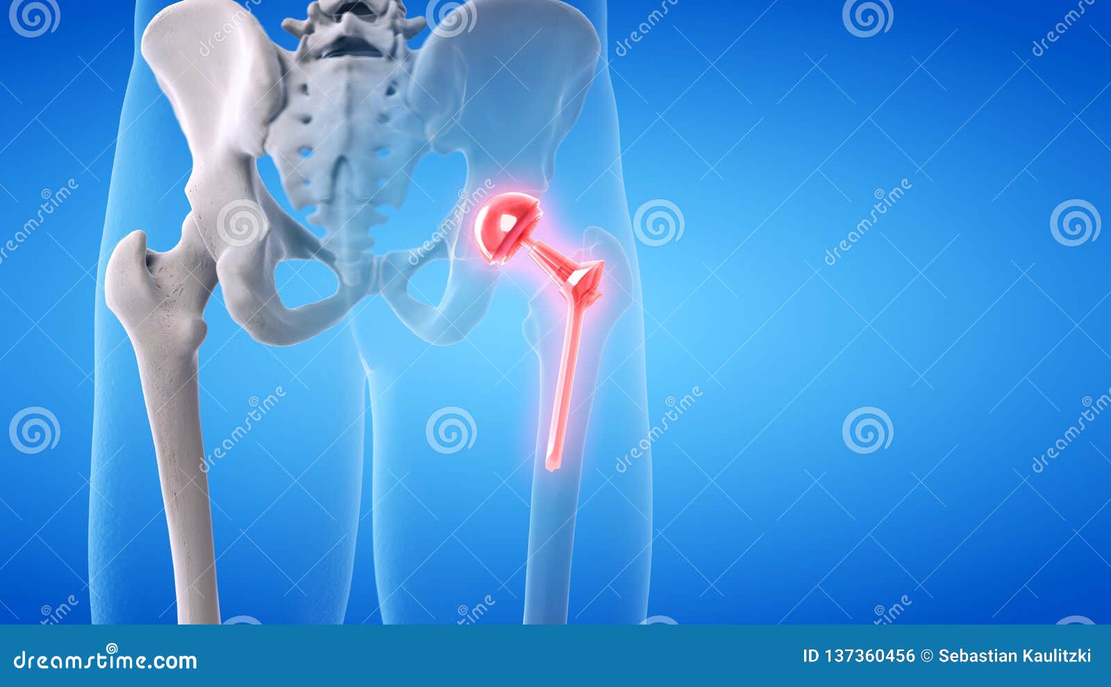 Een Pijnlijke Heupvervanging Stock Illustratie - Illustration of blauw ...