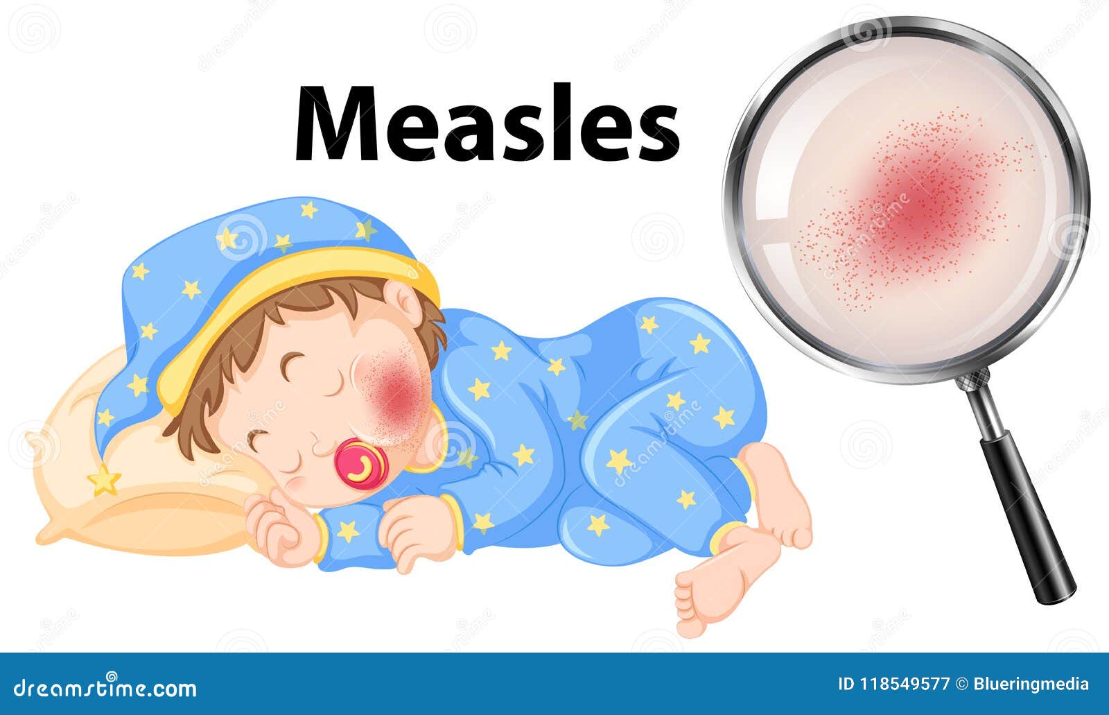 Een Vector Van Mazelen Op Babygezicht Vector Illustratie - Illustration ...