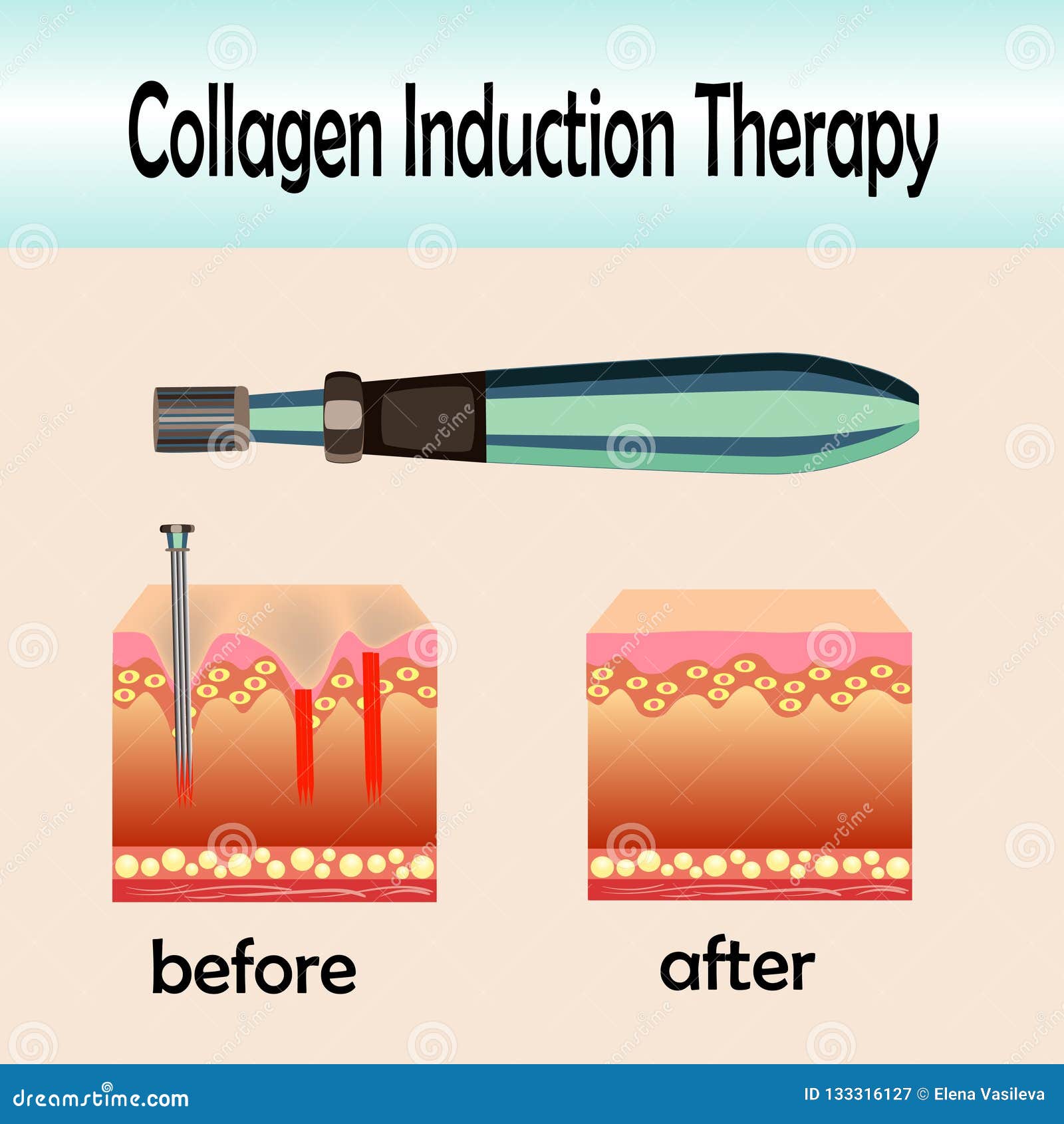 Collagen Induction Therapy. Microneedling The Skin Vector Illustration ...