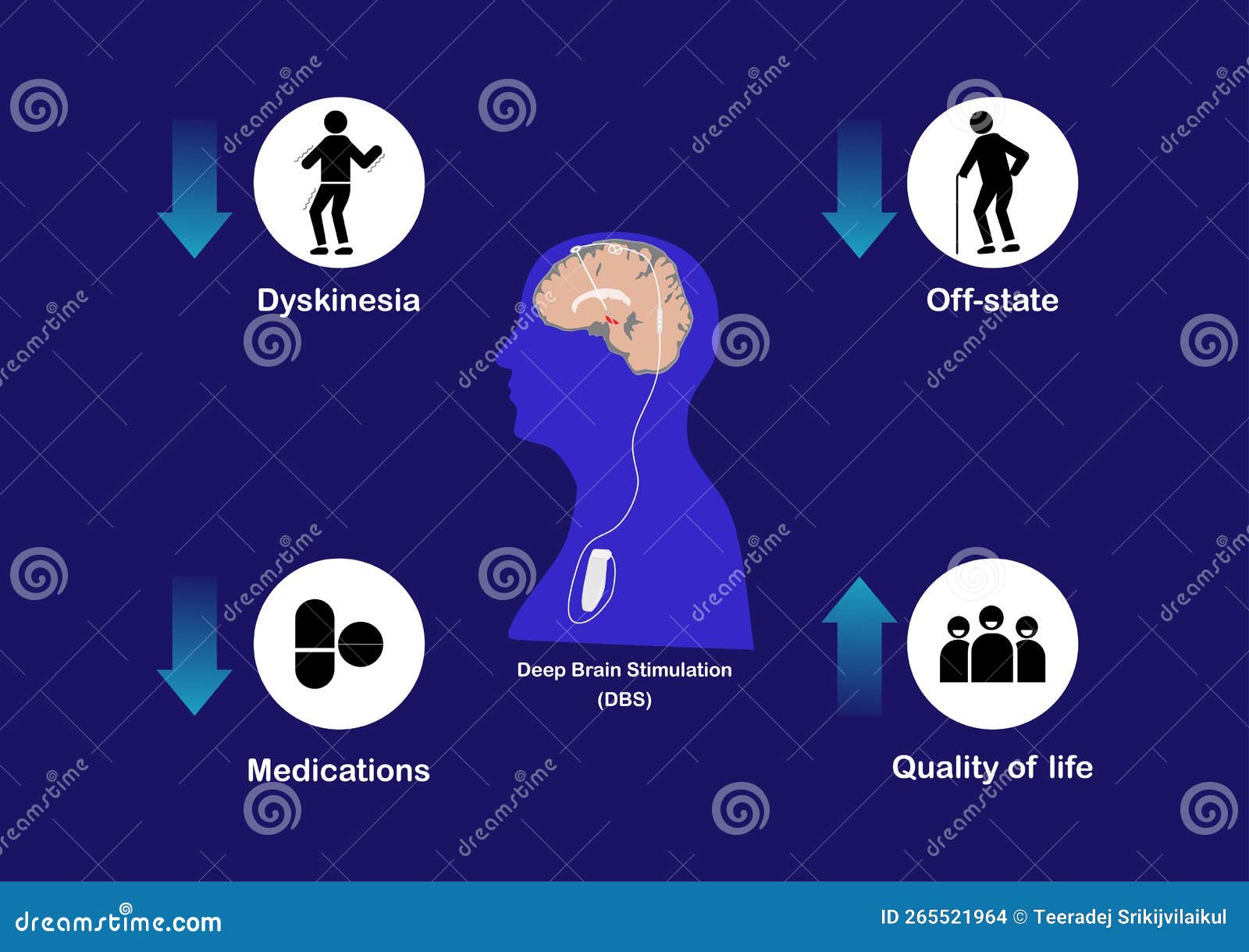 Concepts Of Deep Brain Stimulation For Treatment Of Parkinson`s Disease ... Concepts Of Deep Brain Stimulation For Treatment Of Parkinson`s Disease ...