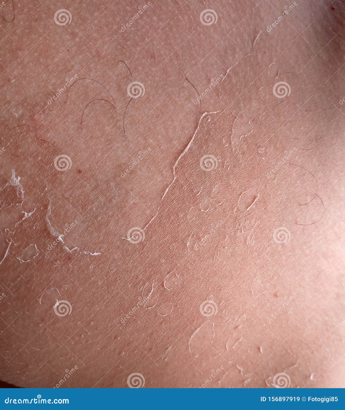 Effects of Sunburn on the Skin. Climb Skin Stock Image - Image of back ...