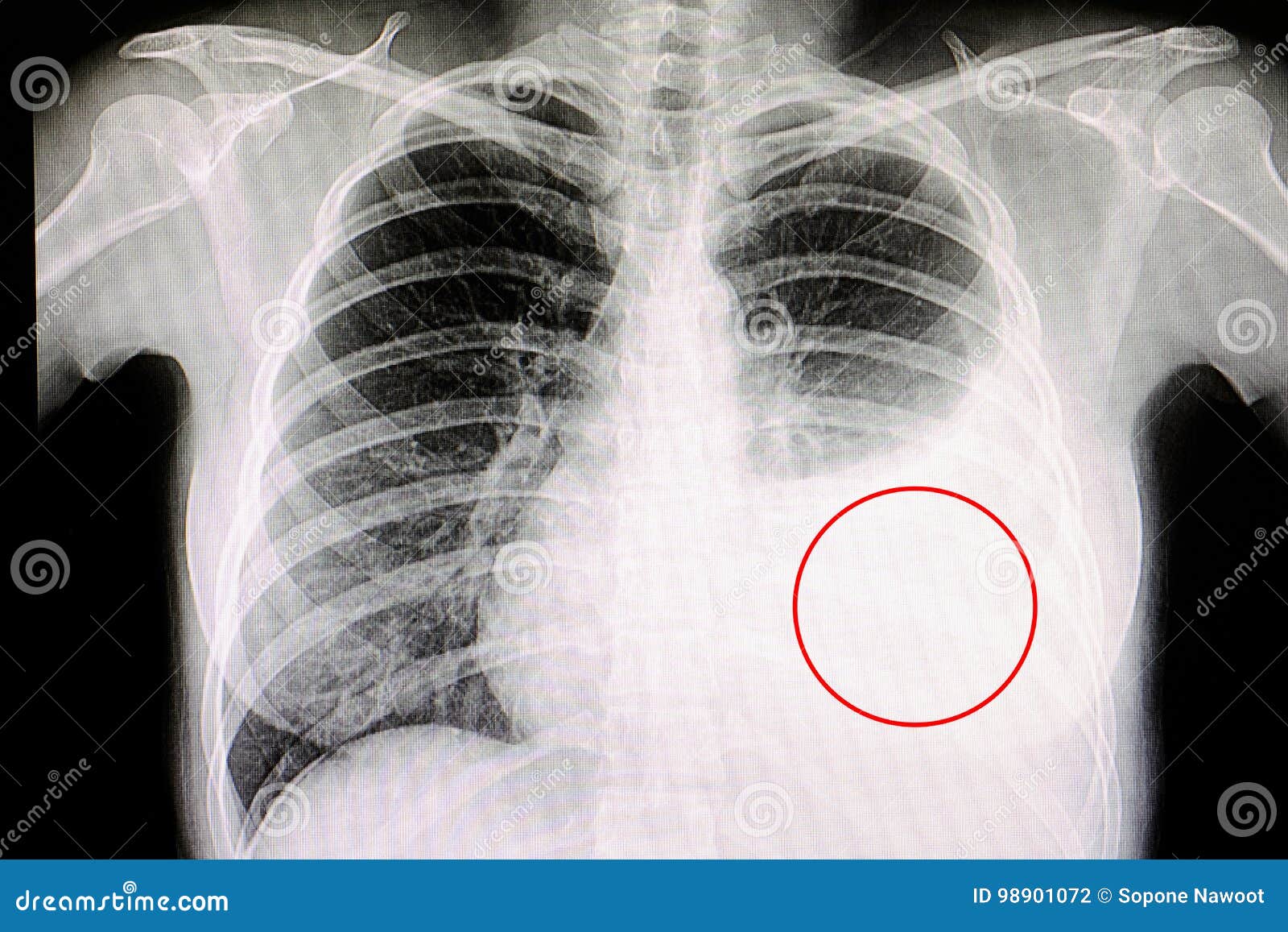 Efusión pleural foto de archivo. Imagen de pleural, pulmonar - 98901072