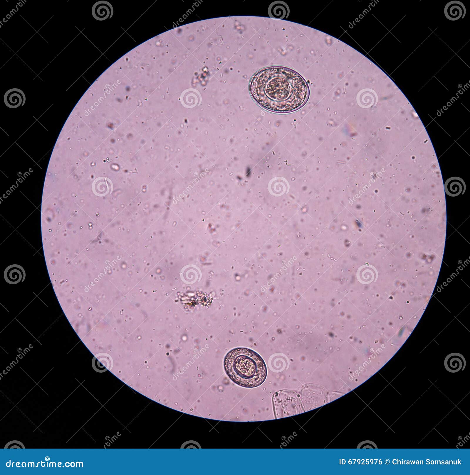 Schistosoma Parasite Ova In Human Urine Specimen Under Microscope Stock ...