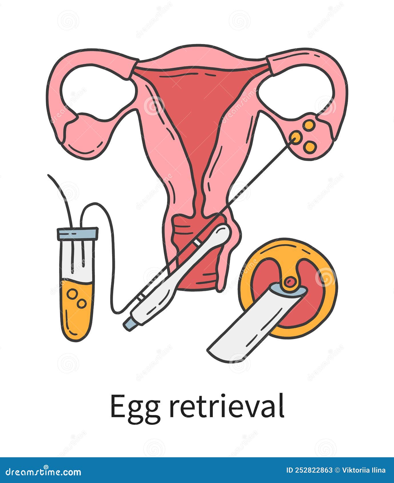Egg Retrieval and Transvaginal Oocyte Extraction from Ovaries, in Vitro ... Egg Retrieval and Transvaginal Oocyte Extraction from Ovaries, in Vitro ...
