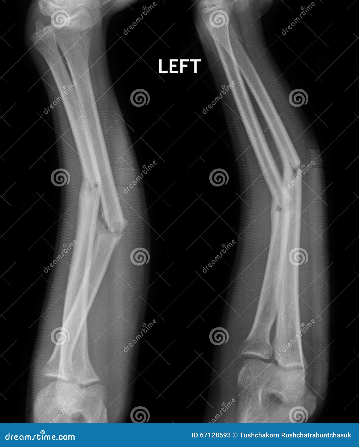 Eixo Da Fratura De Raio & Do Osso Ulnar Imagem de Stock - Imagem de ...