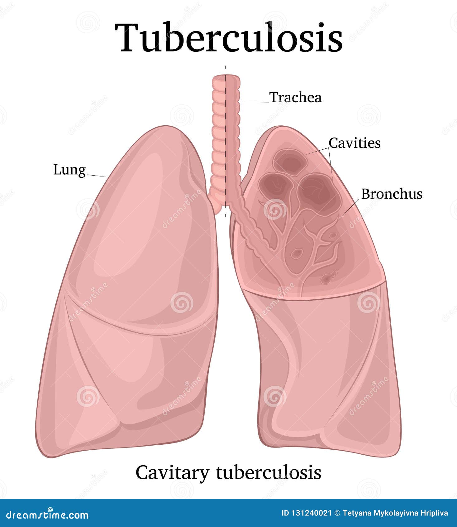 Ejemplo De La Tuberculosis Pulmonar Ilustración del Vector ...
