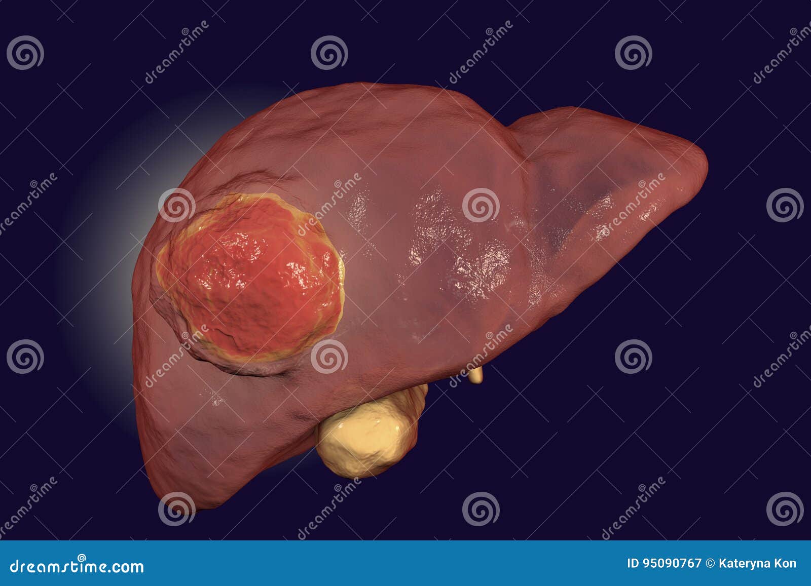 Ejemplo Del Cáncer De Hígado Stock de ilustración - Ilustración de ...
