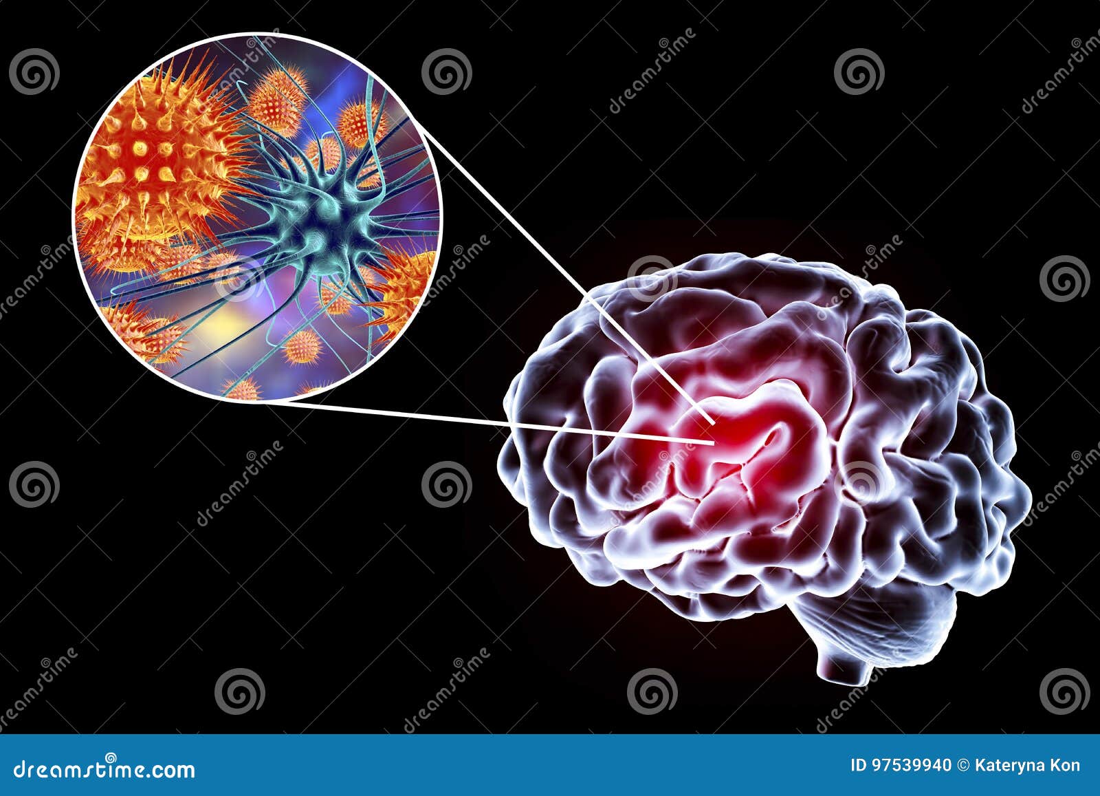 Ejemplo Viral De La Encefalitis Stock de ilustración - Ilustración de ...