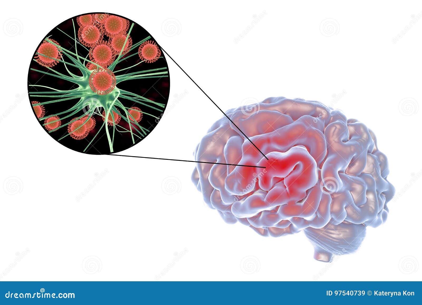 Ejemplo Viral De La Encefalitis Stock de ilustración - Ilustración de ...