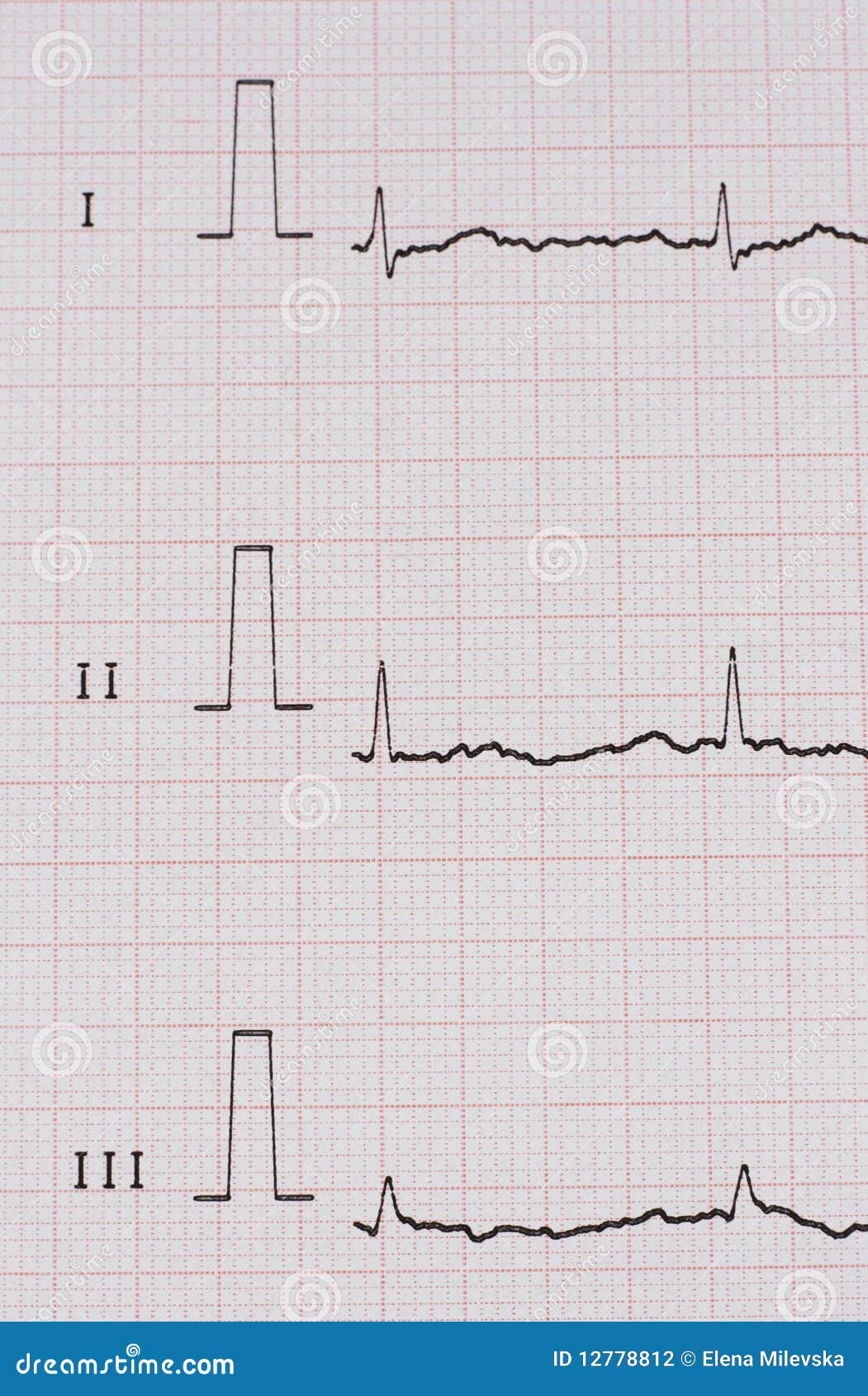 Ekg/ Ecg - Medical Background Stock Photo - Image of medicine ...