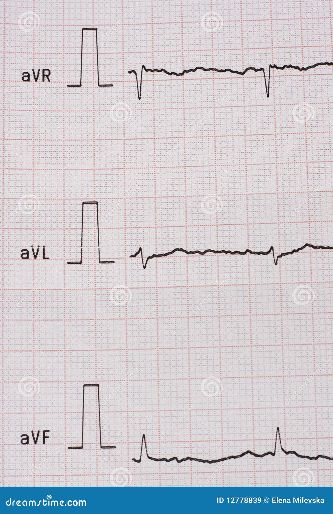 Ekg/ Ecg - Medical Background Stock Image - Image of background ...