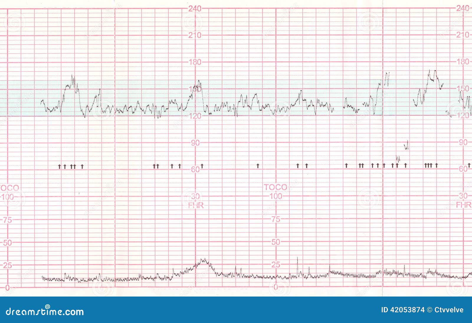 EKG or ECG result stock photo. Image of healthcare, background - 42053874