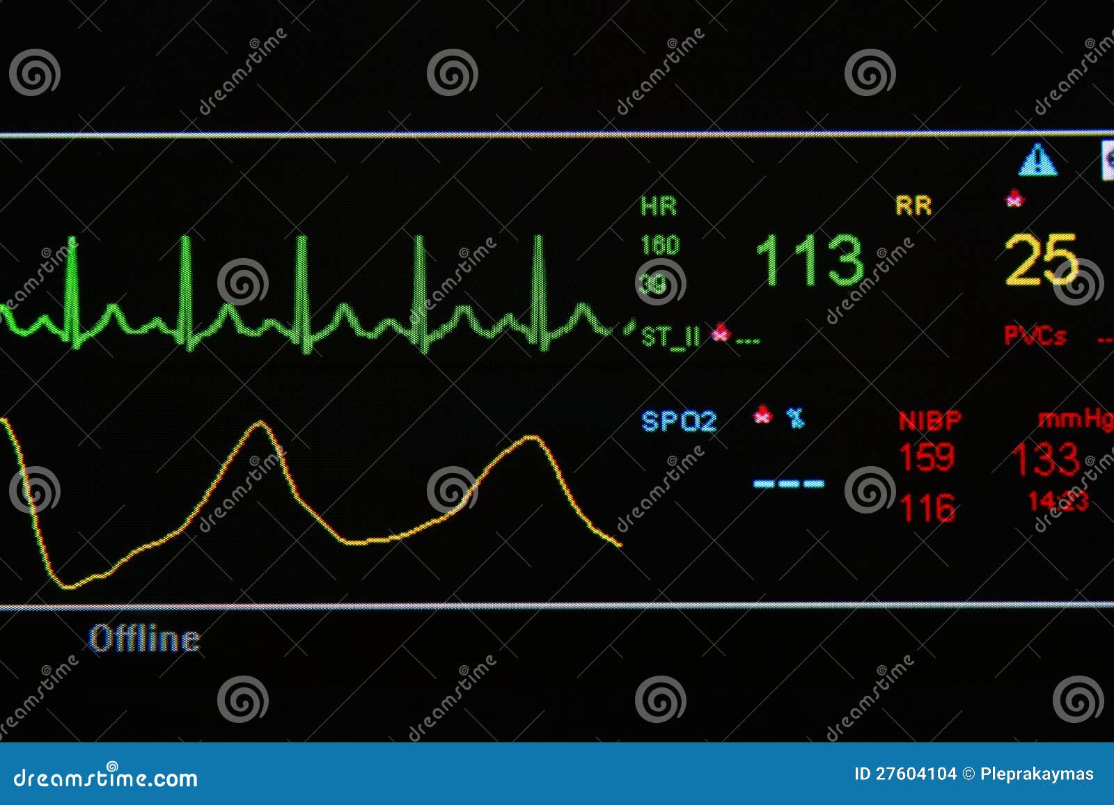 EKG monitor in ICU unit stock photo. Image of electronic - 27604104