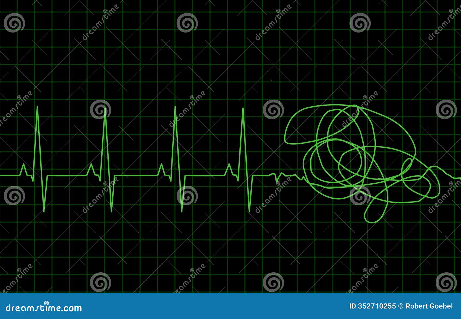 An EKG Pattern of Ups and Downs Turns into a Tangled Line in an ...