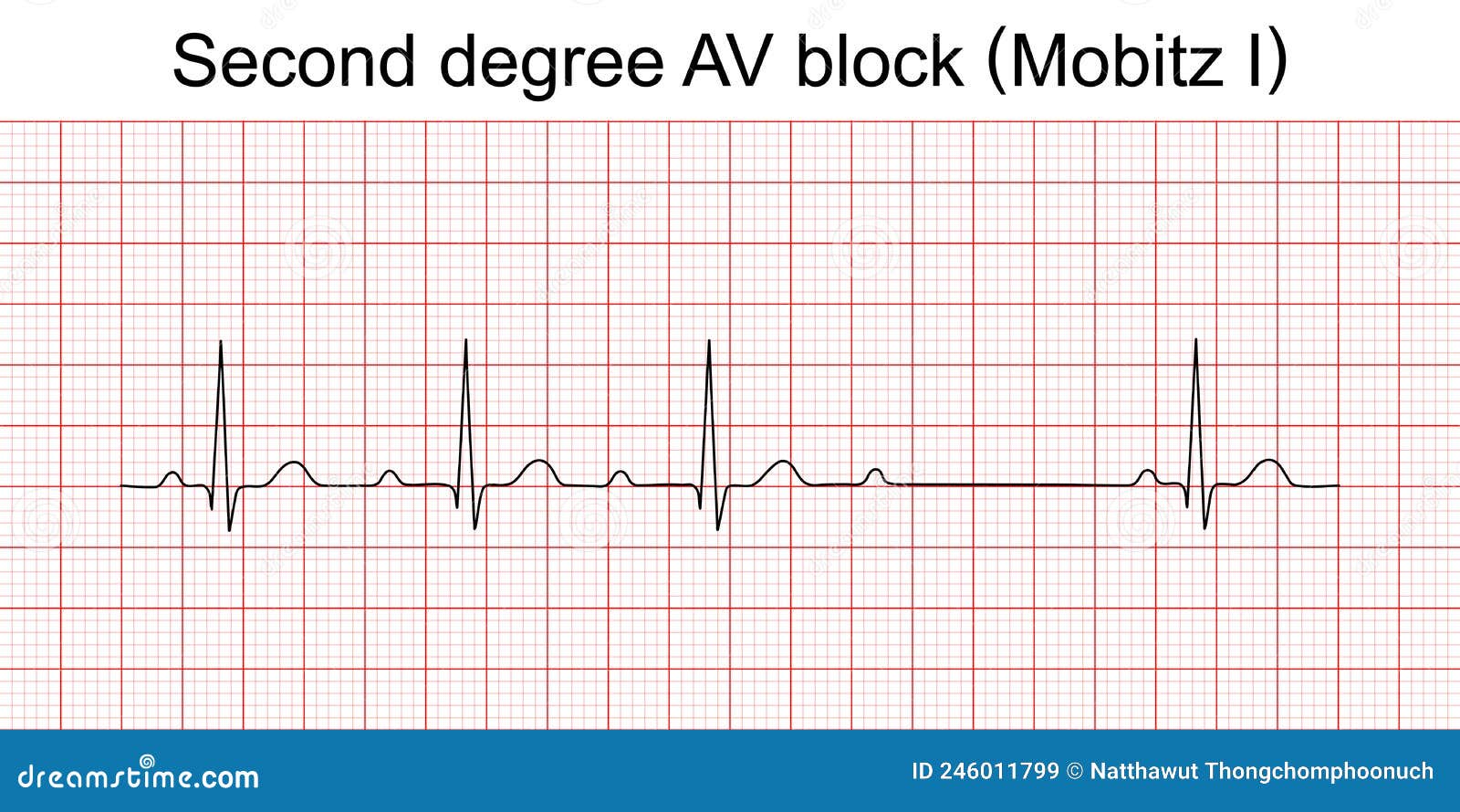 EKG Second Degree AV Block Mobitz I Stock Vector - Illustration of ... EKG Second Degree AV Block Mobitz I Stock Vector - Illustration of ...