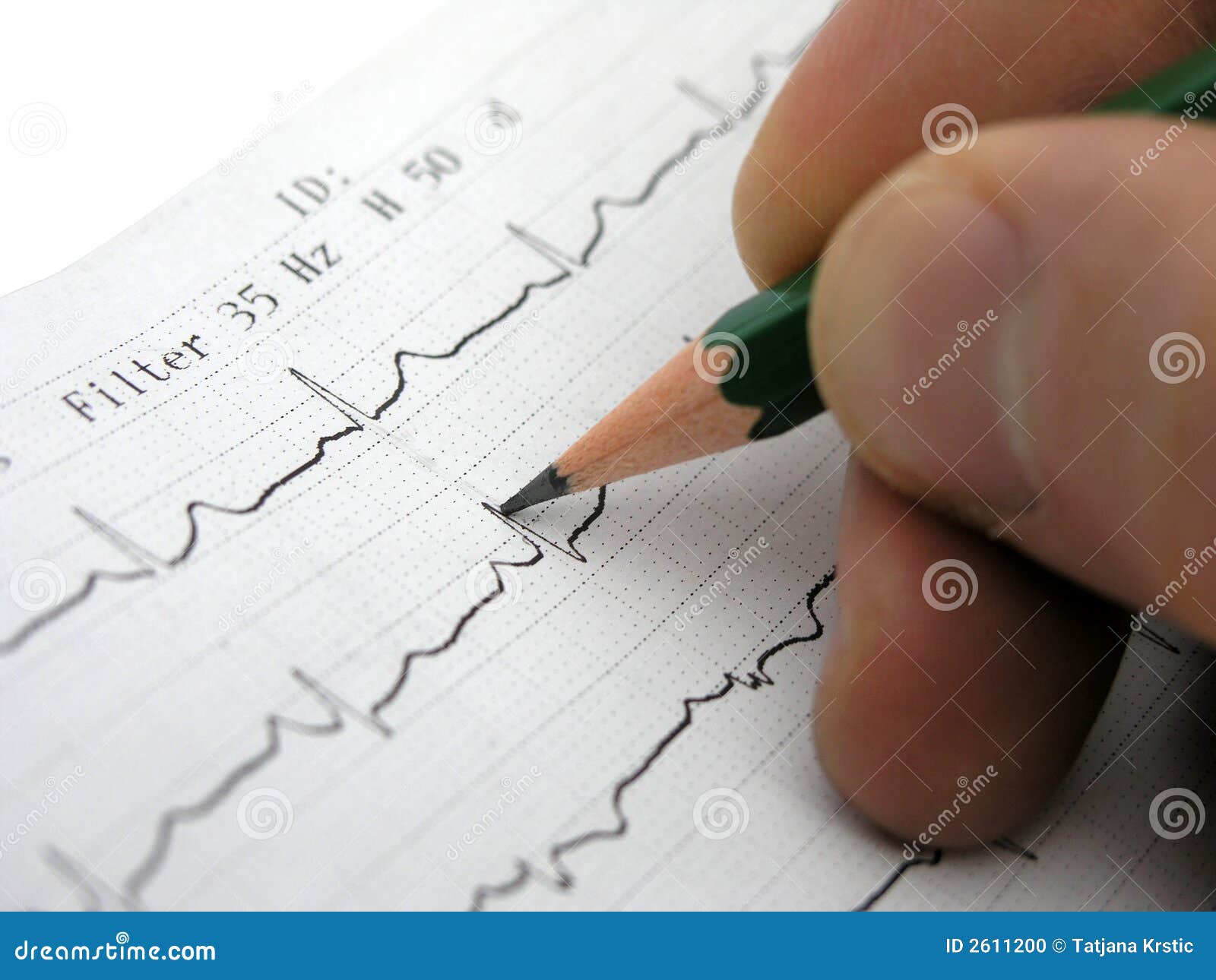 EKG test results stock photo. Image of cardiologist, pencil - 2611200