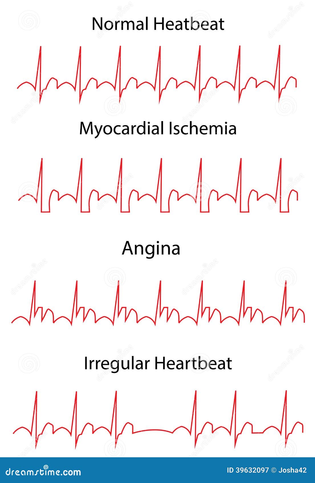 EKG Traces of Normal and Pathologies Stock Illustration - Illustration ...