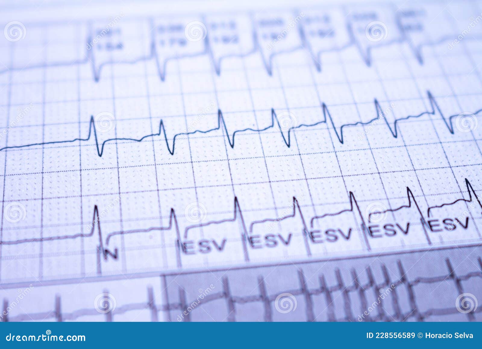 EKG Tracing with Heartbeat. Study for the Heart Stock Image - Image of ...