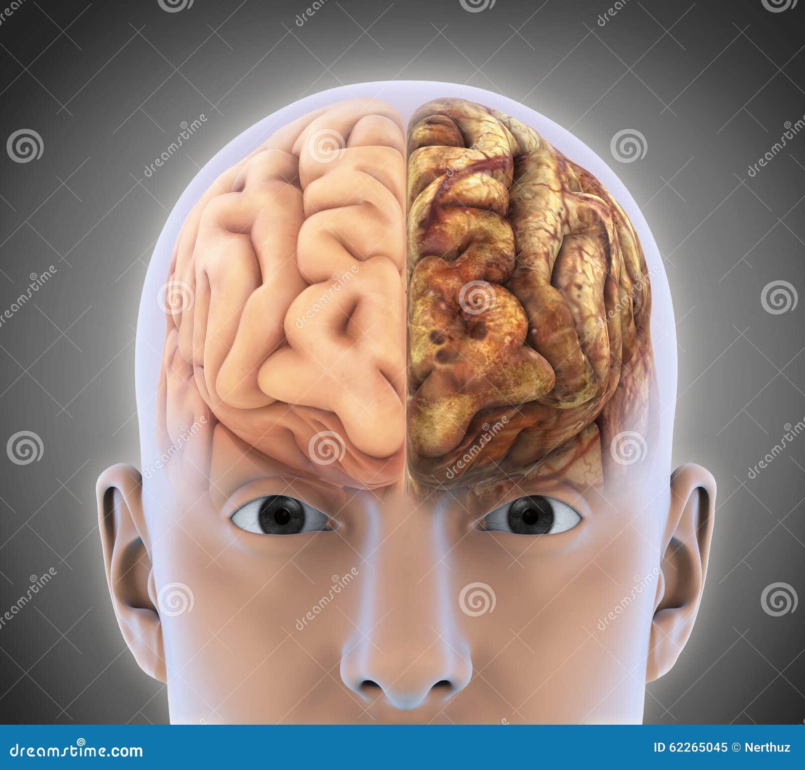 El Cerebro Sano Y El Cerebro Malsano Stock de ilustración - Ilustración ...