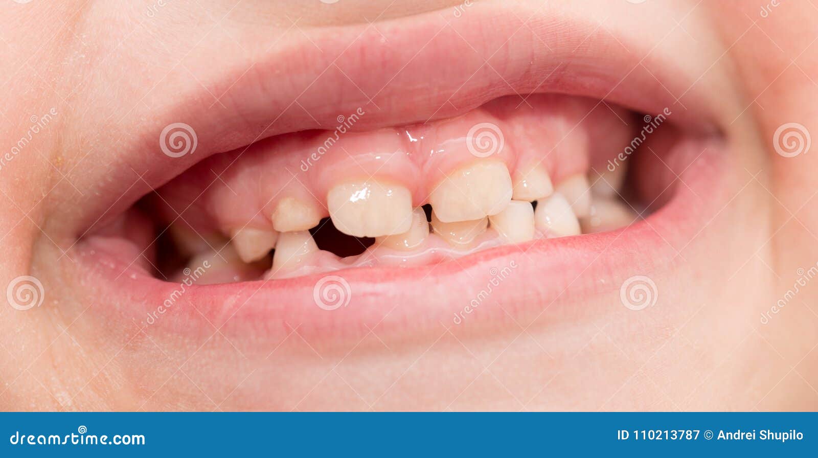 El Muchacho Muestra Una Boca Abierta Imagen de archivo - Imagen de boca ...