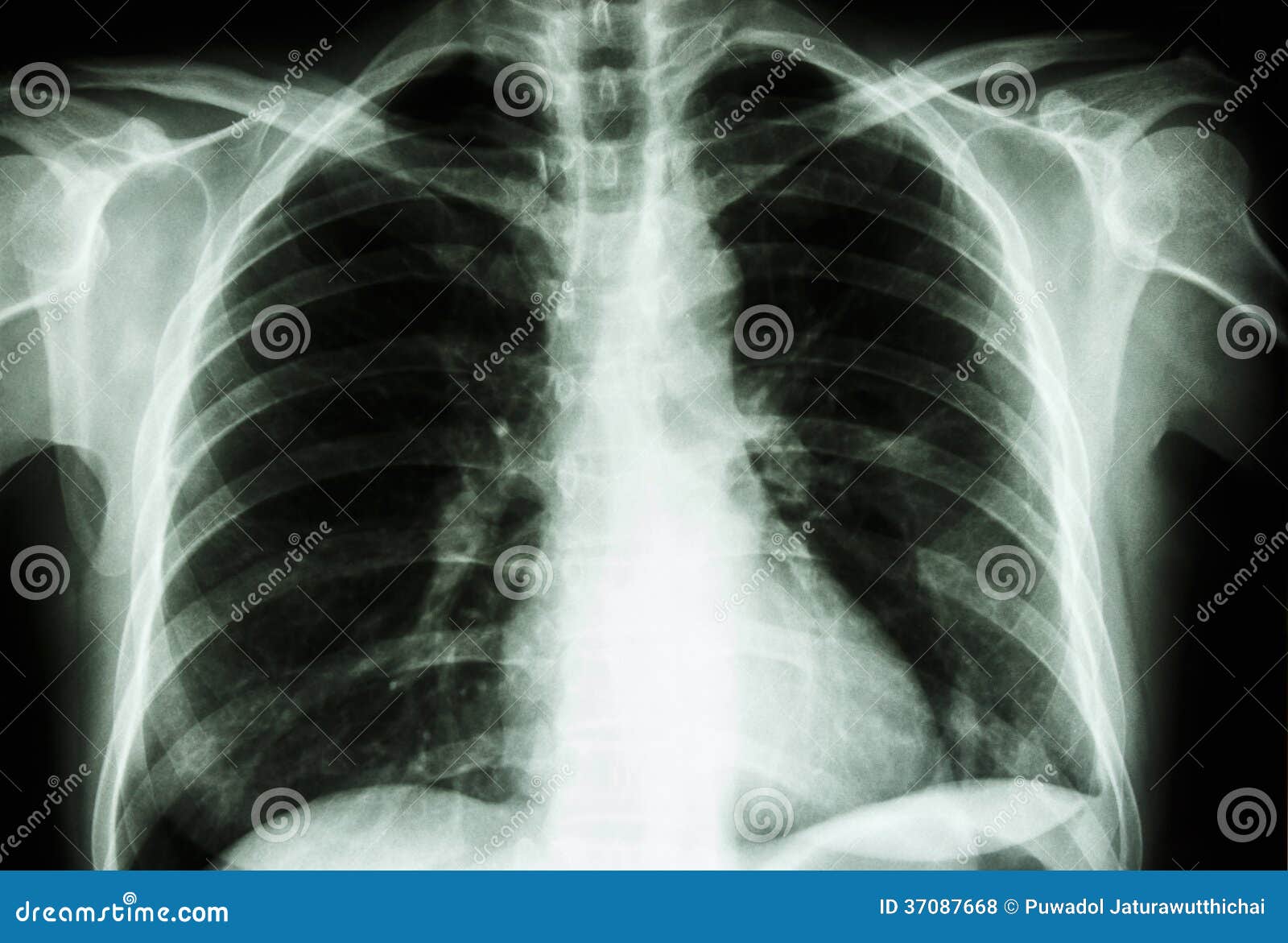 El Pecho Normal Del Ser Humano Foto de archivo - Imagen de imagen ...