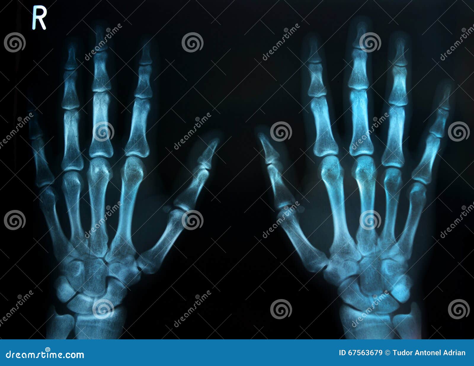 El ser humano da el rayo x imagen de archivo. Imagen de médico - 67563679