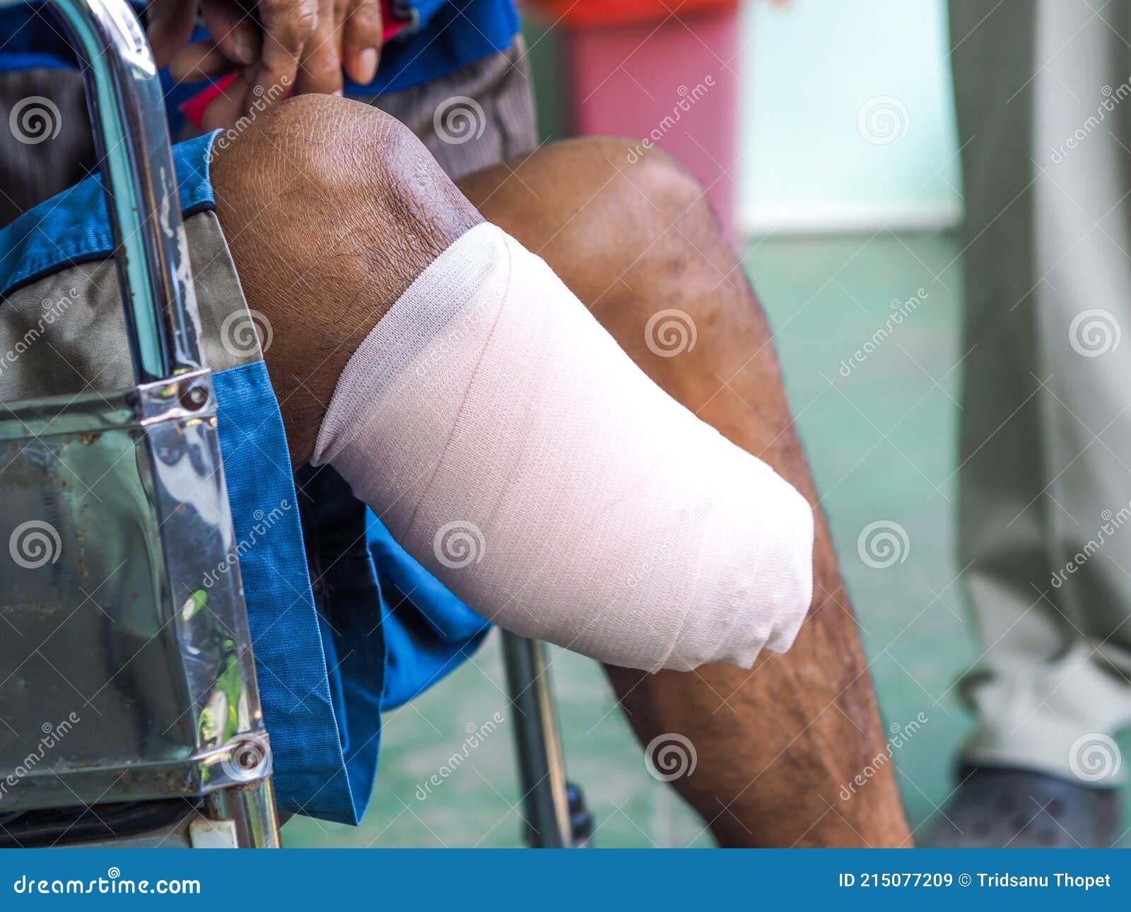 Elastic Bandaged Below Knee Amputation Stock Image - Image of disabled ...