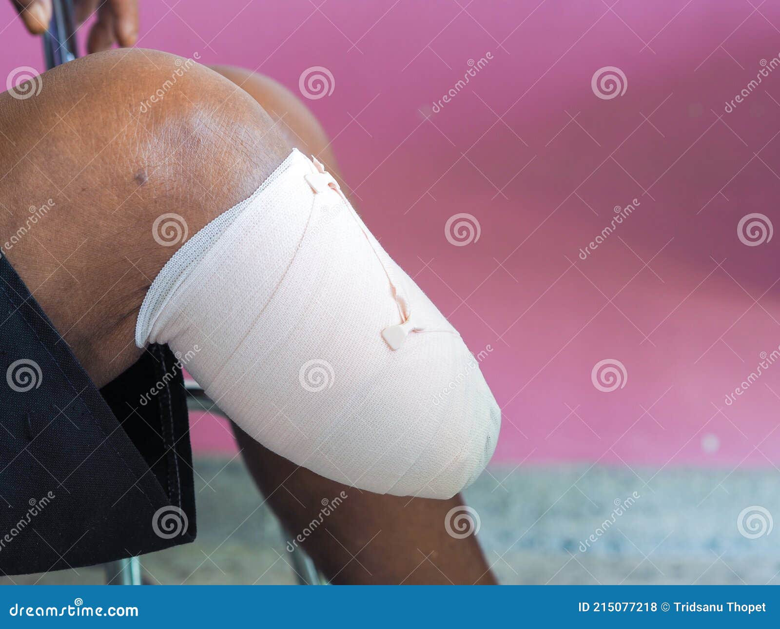 Elastic Bandaged Below Knee Amputation Stock Photo - Image of compress ...
