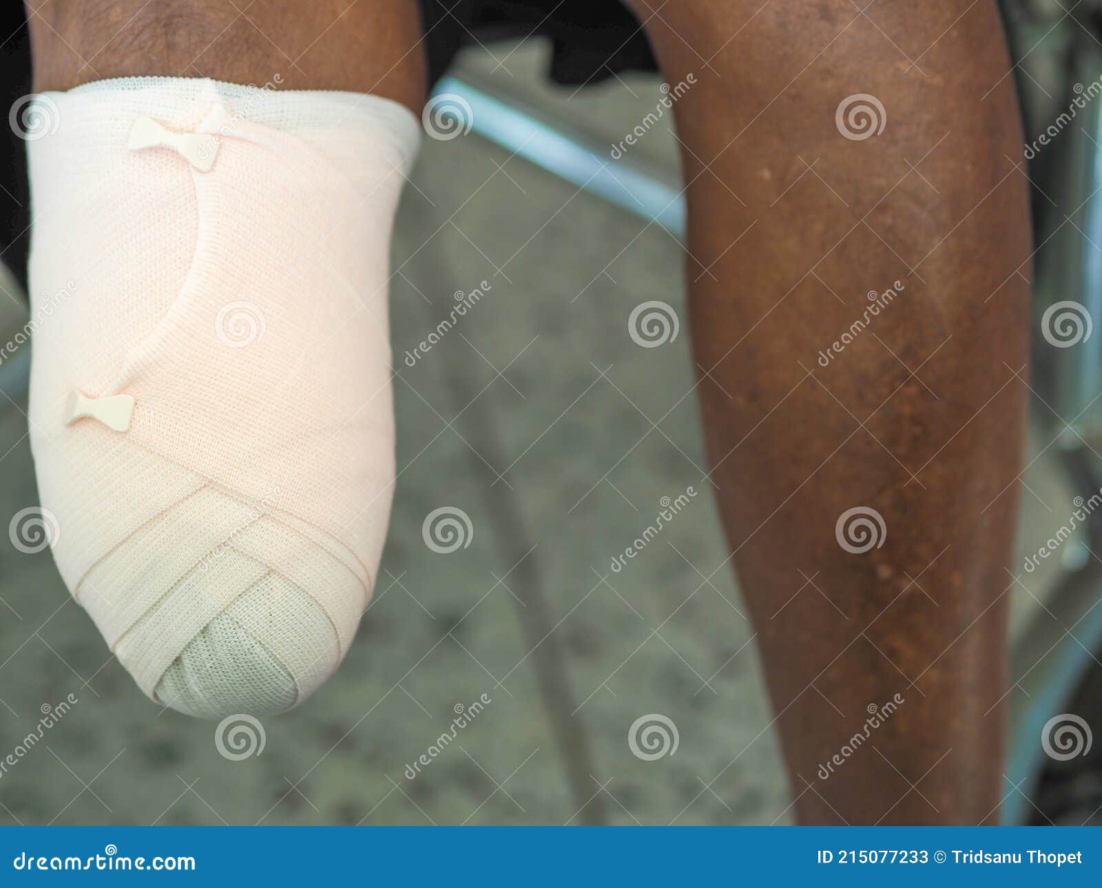 Elastic Bandaged Below Knee Amputation Stock Image - Image of ...
