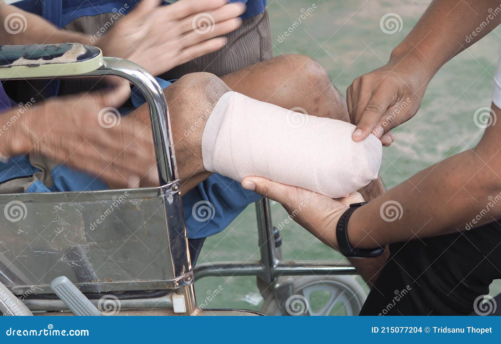 Elastic Bandaged Below Knee Amputation Stock Photo - Image of injury ...