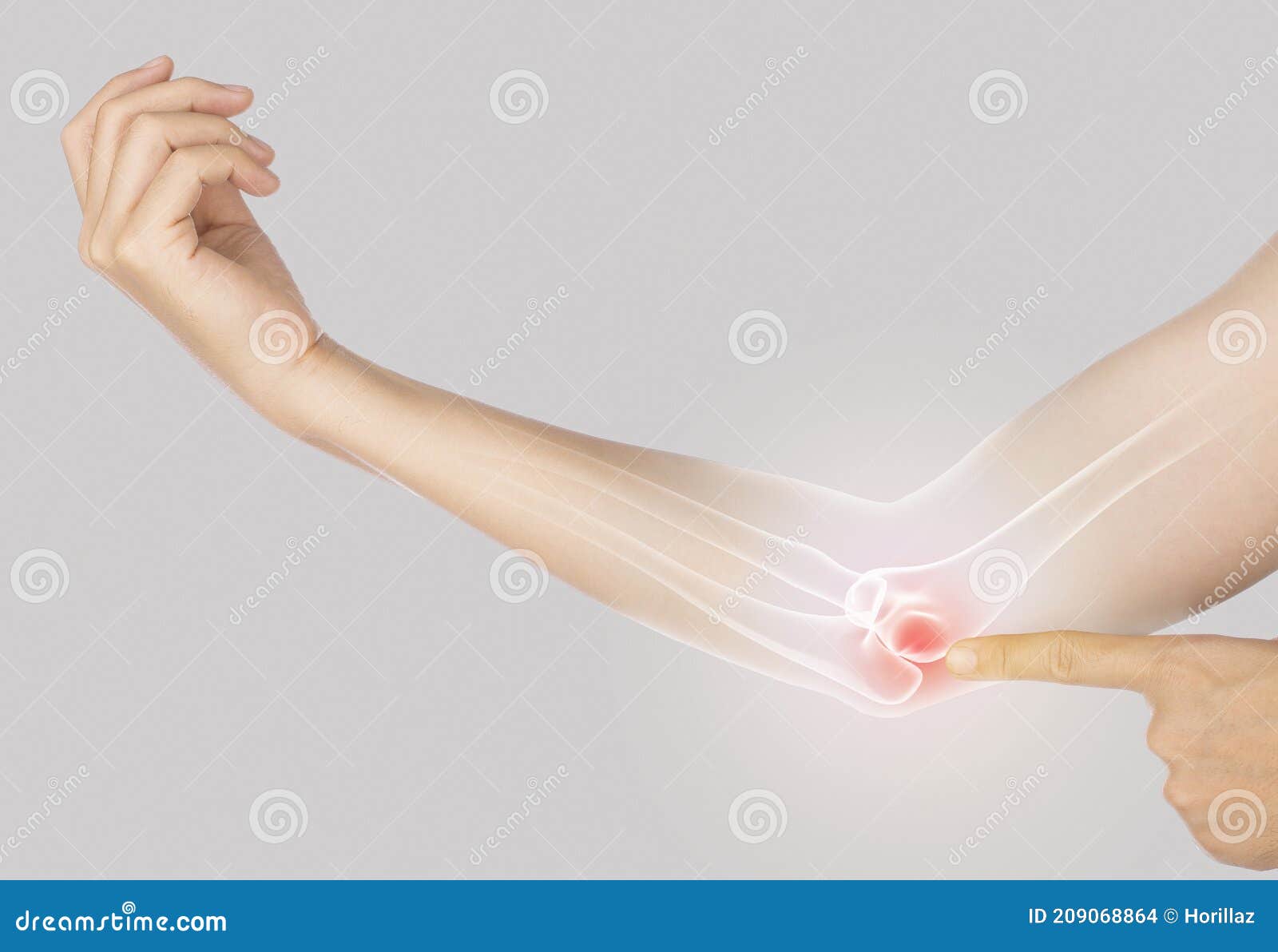 Elbow bones injury stock photo. Image of illness, office - 209068864