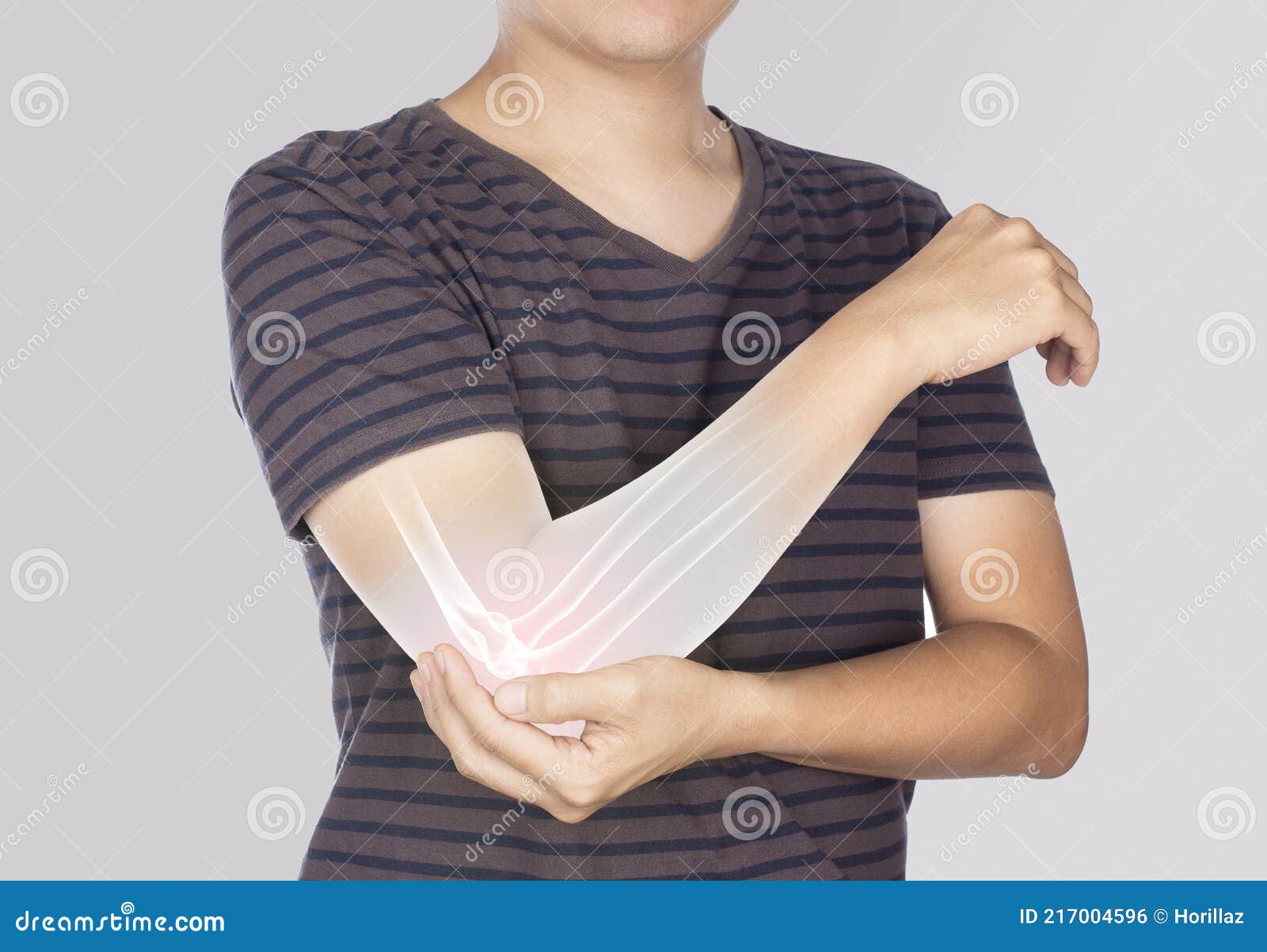 Elbow bones injury stock photo. Image of motion, bone - 217004596