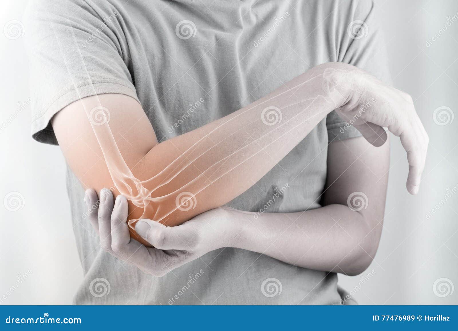 Elbow bones injury stock image. Image of calcium, bone - 77476989