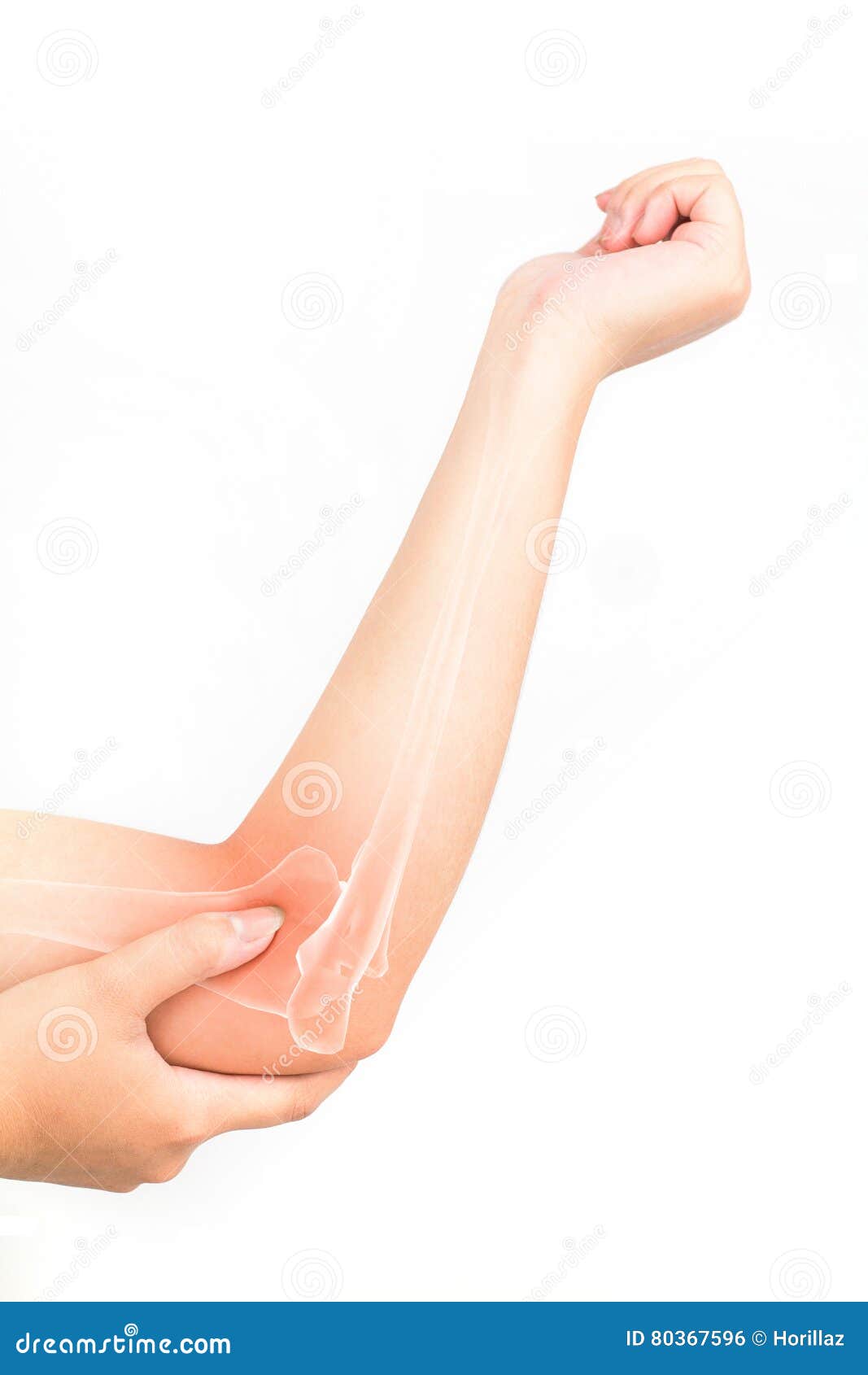 Elbow bones injury stock photo. Image of orthopedic, physical - 80367596