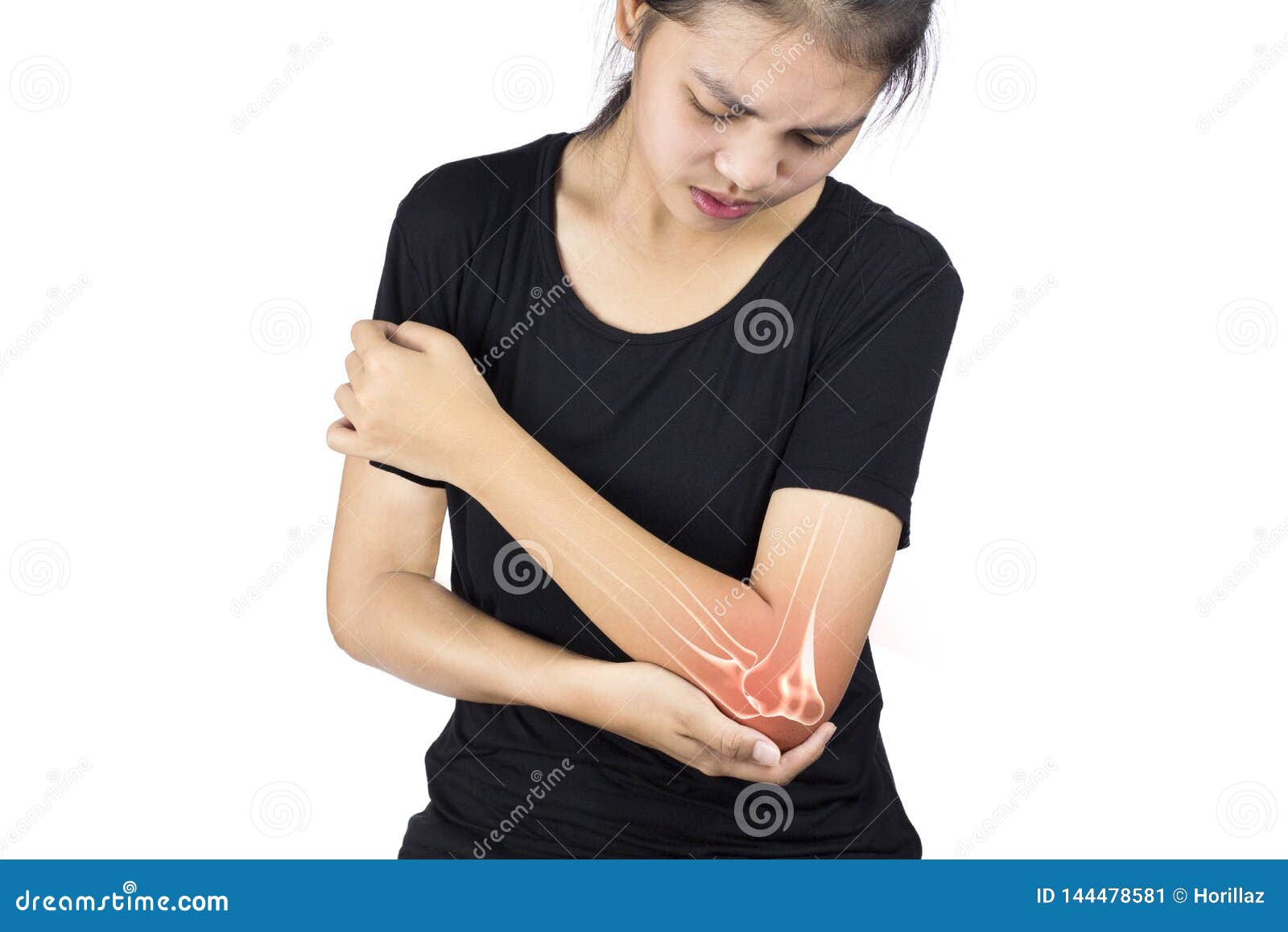 Elbow bones injury stock image. Image of bones, disease - 144478581
