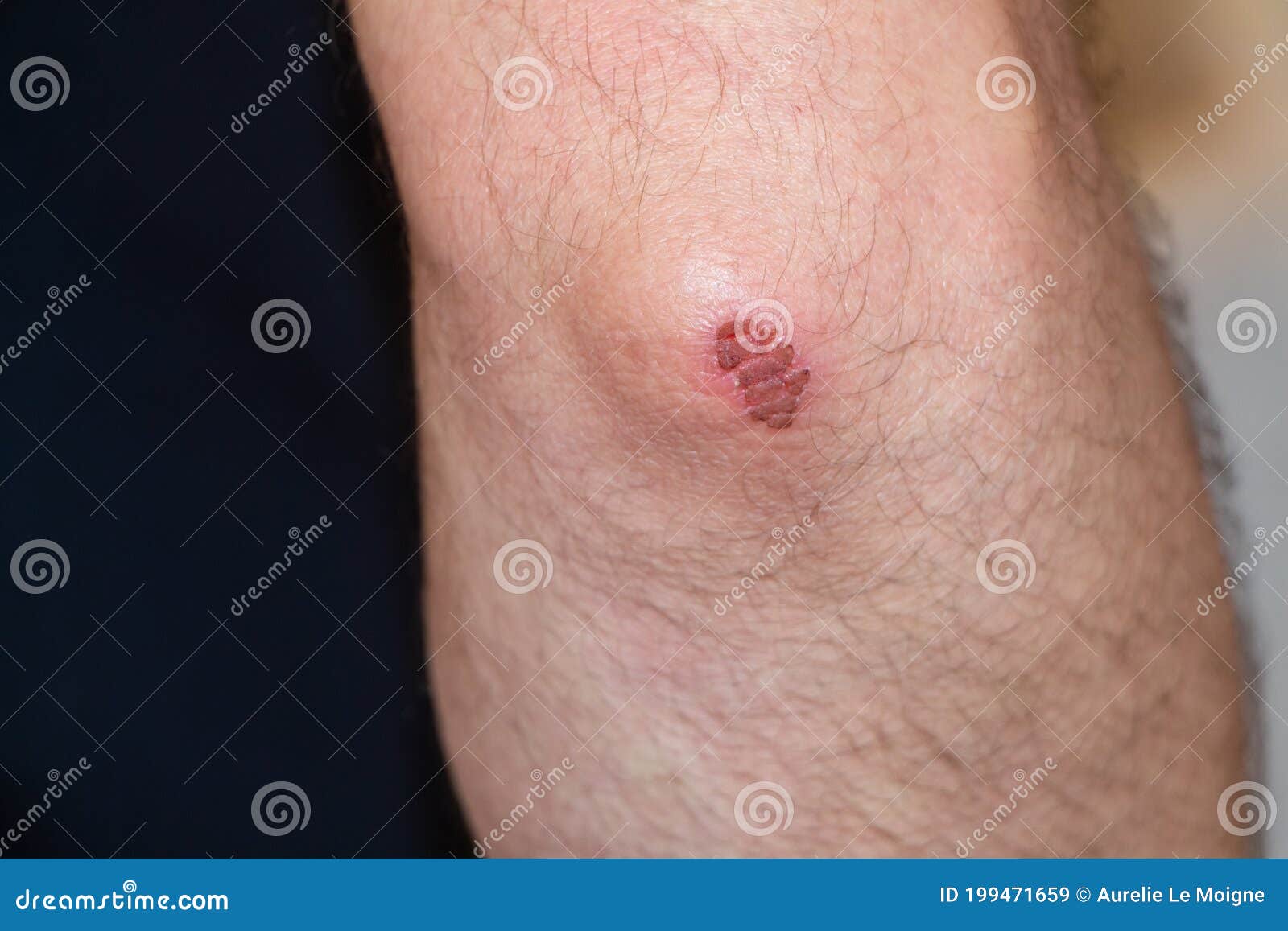 Elbow grazed stock image. Image of scrape, health, graze - 199471659